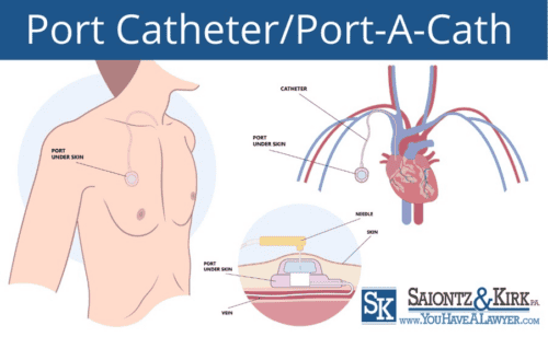Port Catheter Lawsuits - Saiontz & Kirk, P.A.