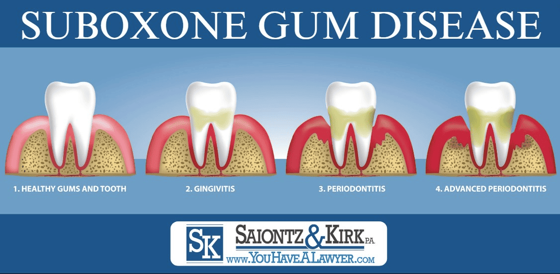 Suboxone Dental Side Effects - Saiontz & Kirk - YouHaveALawyer.com