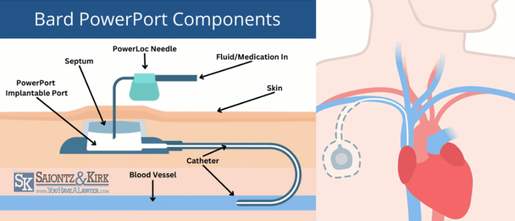 Bard PowerPort Lawsuit - Catheter Fractures, Migrations & Infections ...